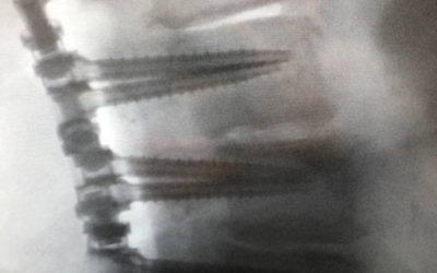 4-level fusion - Nexus Spine