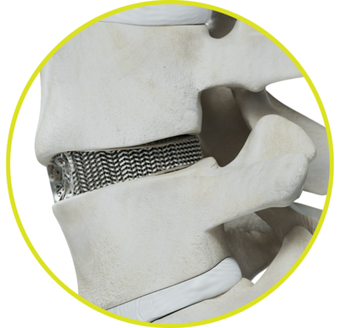 Patient Tranquil Brochure - Nexus Spine