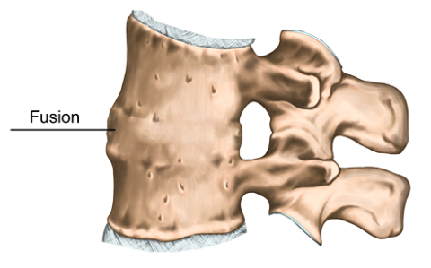 Patient Tranquil Brochure - Nexus Spine