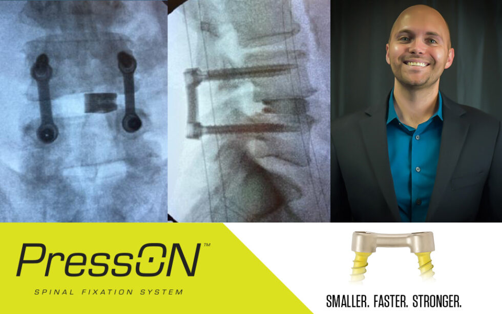1st PressON™ case in Arizona - Nexus Spine