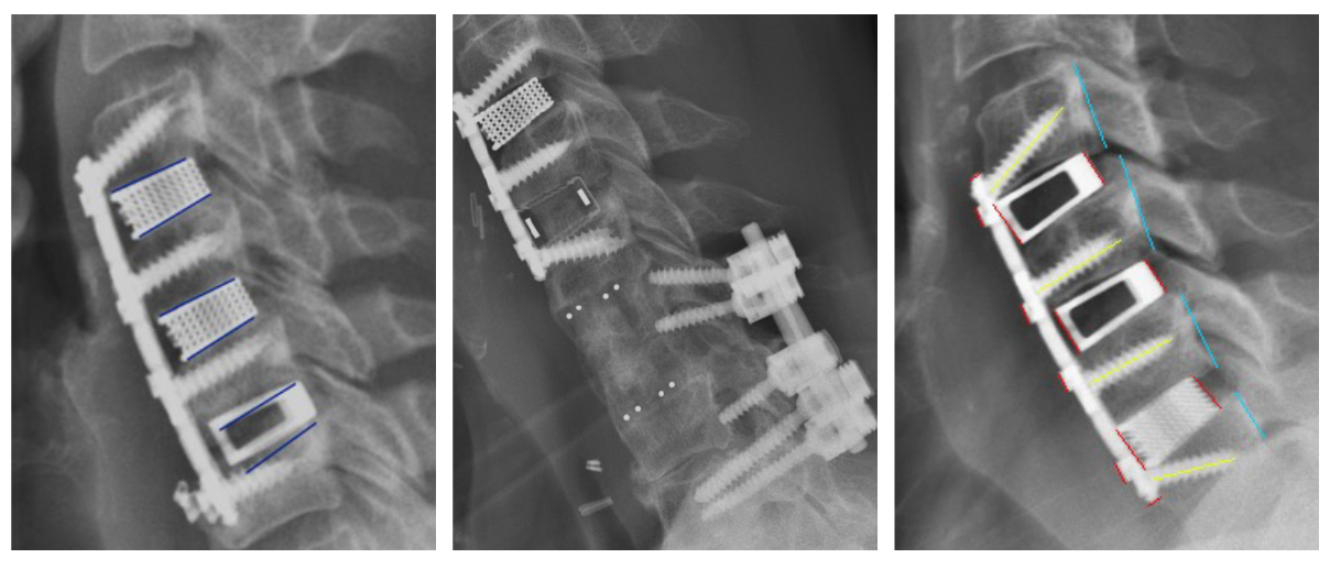 Nexus Spine’s Patented Tranquil® Interbody Implants Achieve Exceptional ...